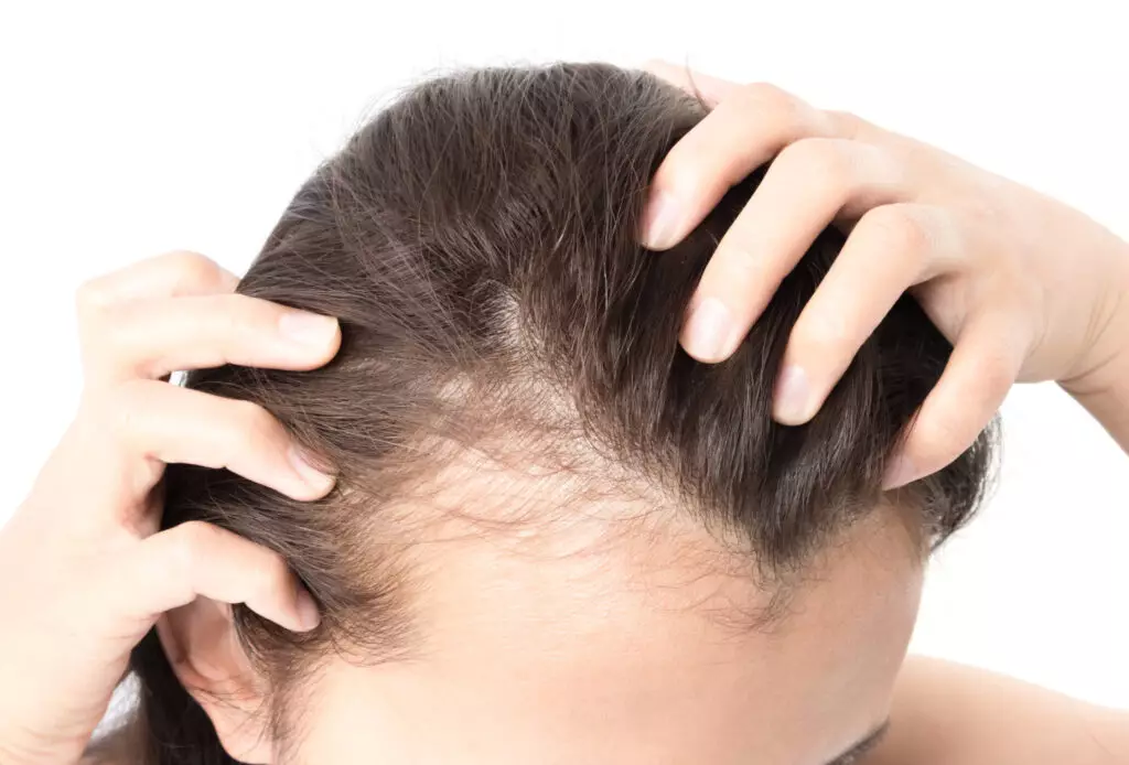 Una mujer con pérdida de cabello.