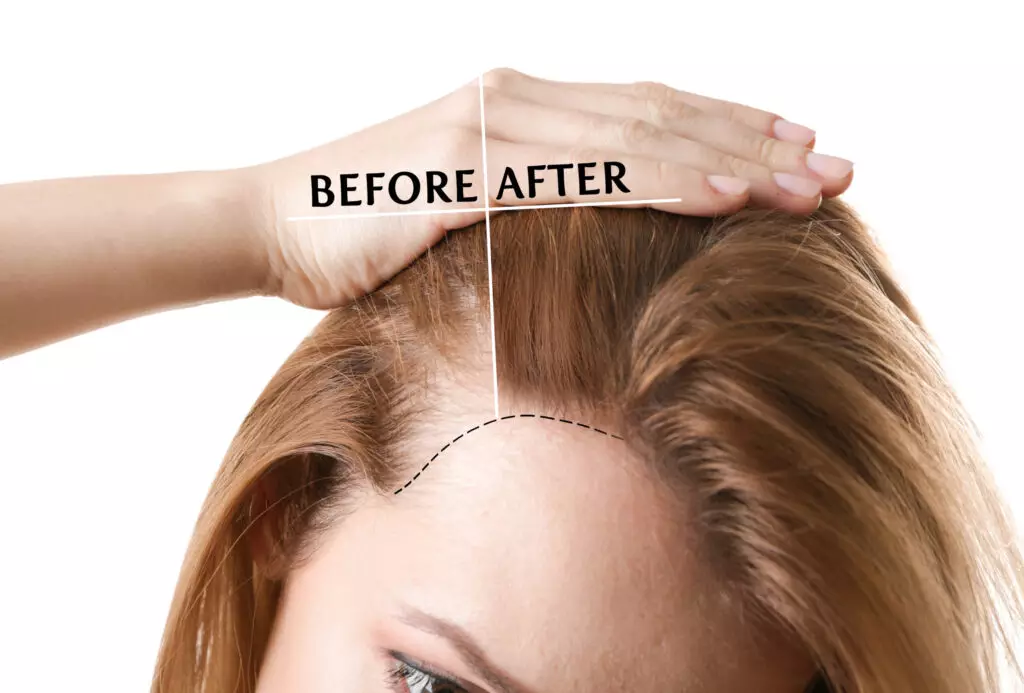 Foto de antes y después que muestra a una mujer con cabello ralo y más abundante.